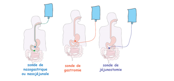 Sondes d'alimentation : gastrostomie, gastro-jéjunostomie